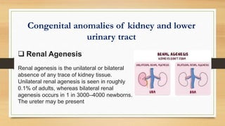 Congenital Anomalies Of UG System PATHOLOGY.pptx