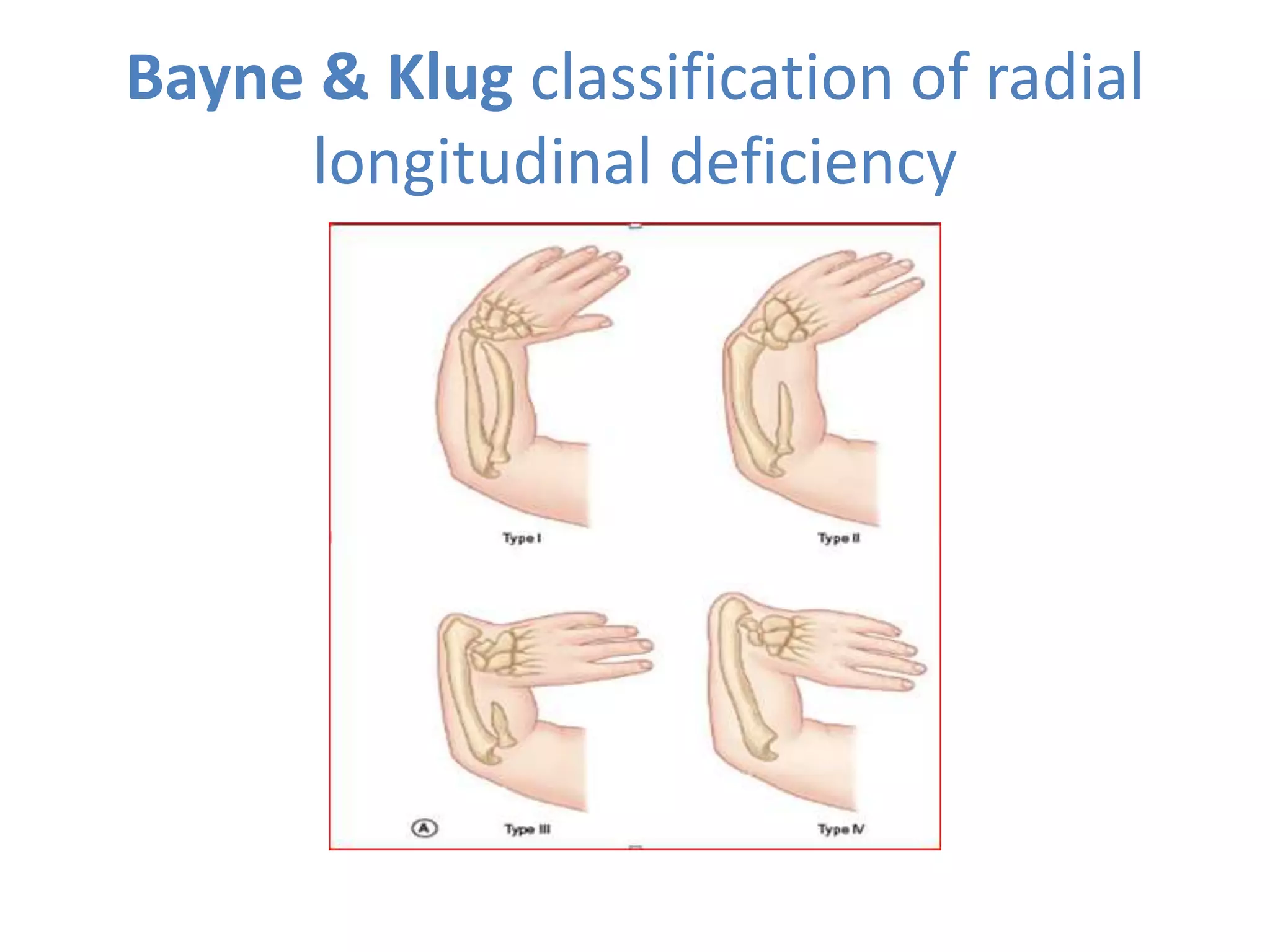 Congenital anomalies of upper limb | PPTX