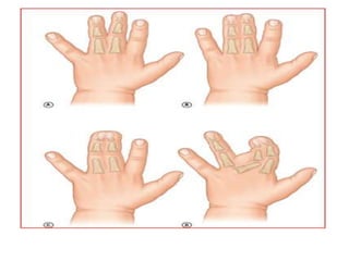 Congenital anomalies of upper limb | PPTX
