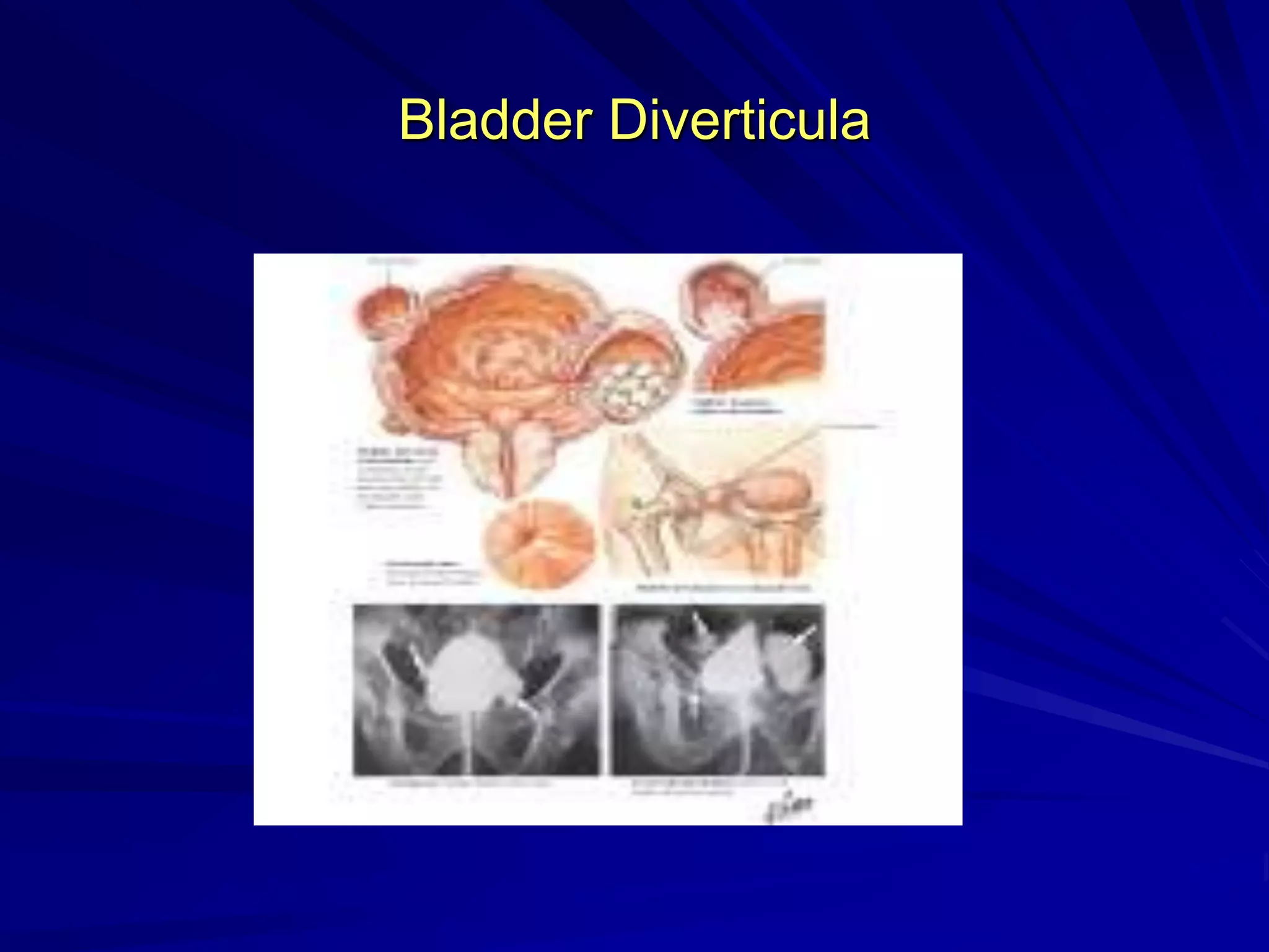 congenital_anomalies_of_urinary_bladder.ppt