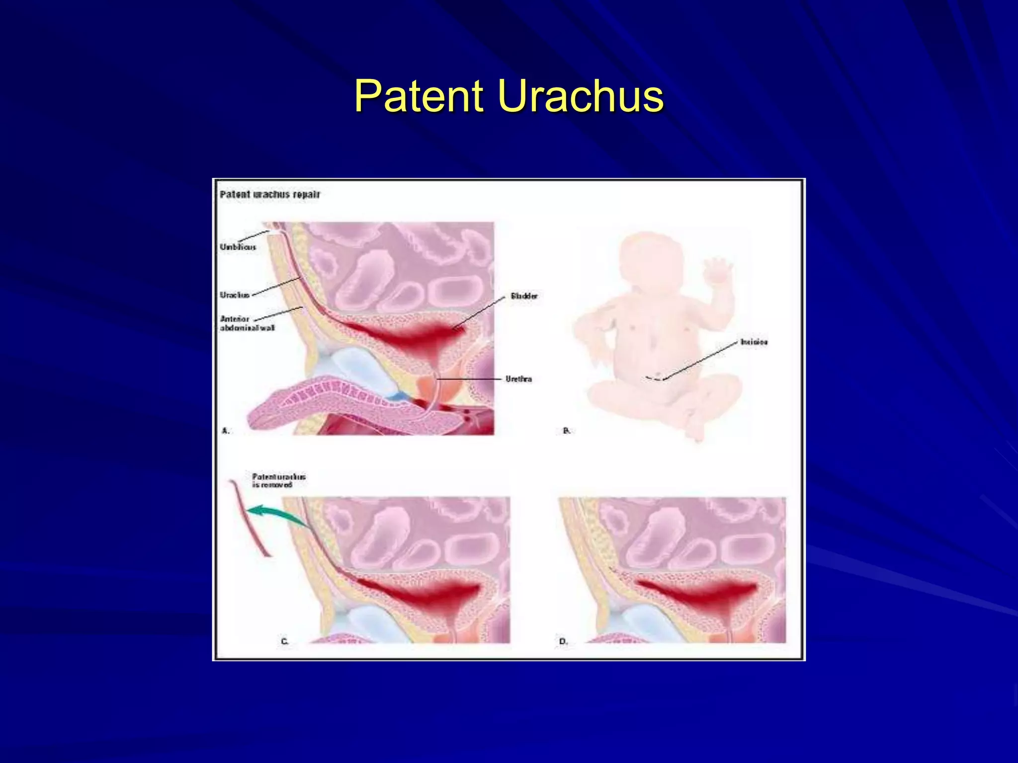 congenital_anomalies_of_urinary_bladder.ppt