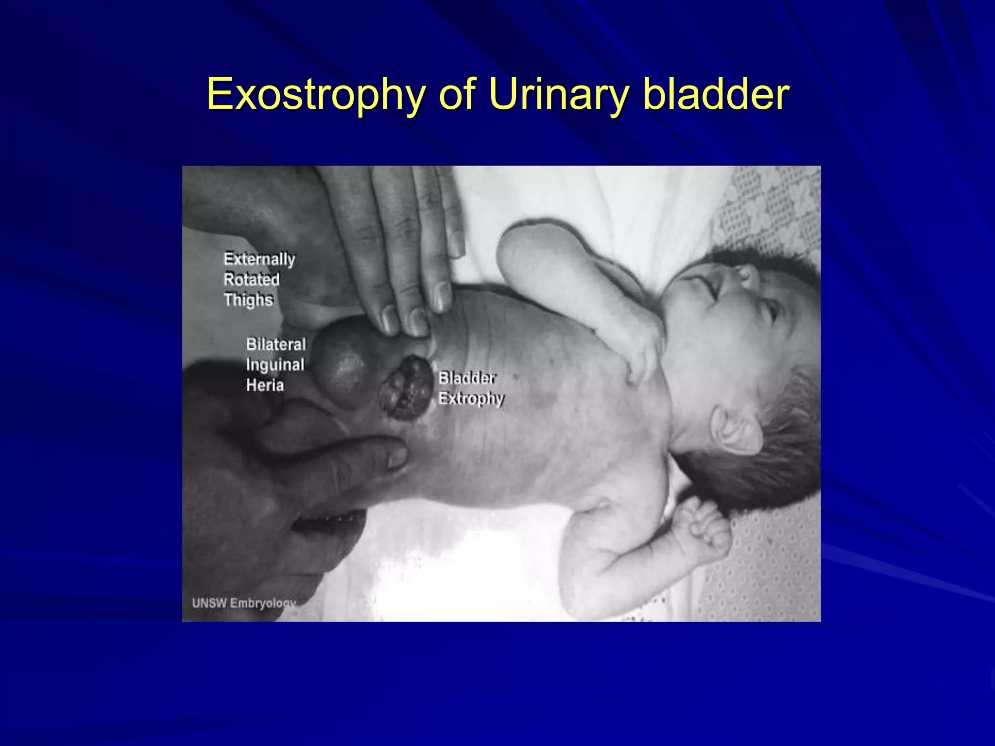congenital_anomalies_of_urinary_bladder.ppt