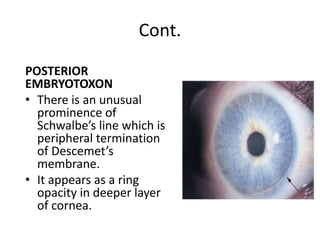 Posterior Embryotoxon