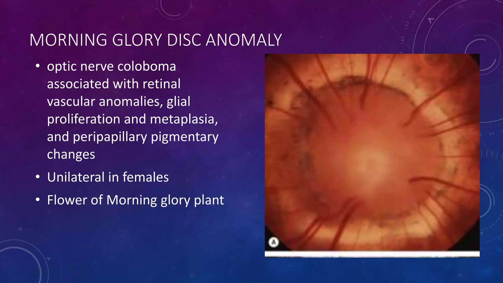 optic disc anomaly | PPTX
