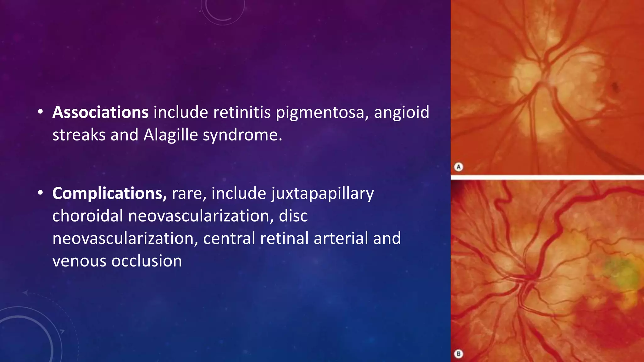 optic disc anomaly | PPTX