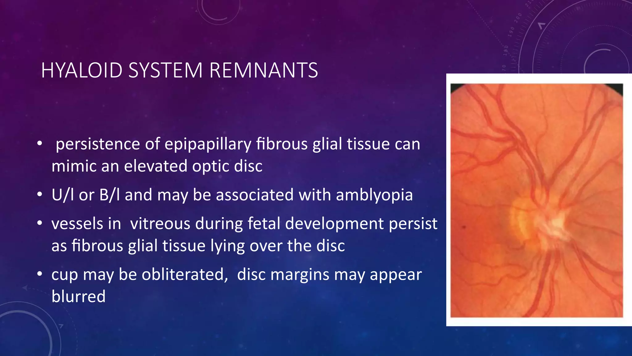 optic disc anomaly | PPTX