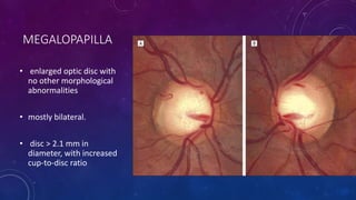 optic disc anomaly | PPT