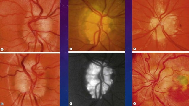 optic disc anomaly | PPTX | Eye and Vision Conditions | Diseases and ...