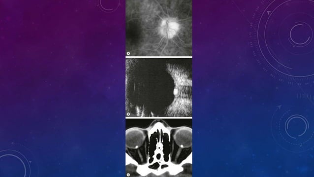 Optic Disc Anomaly Ppt