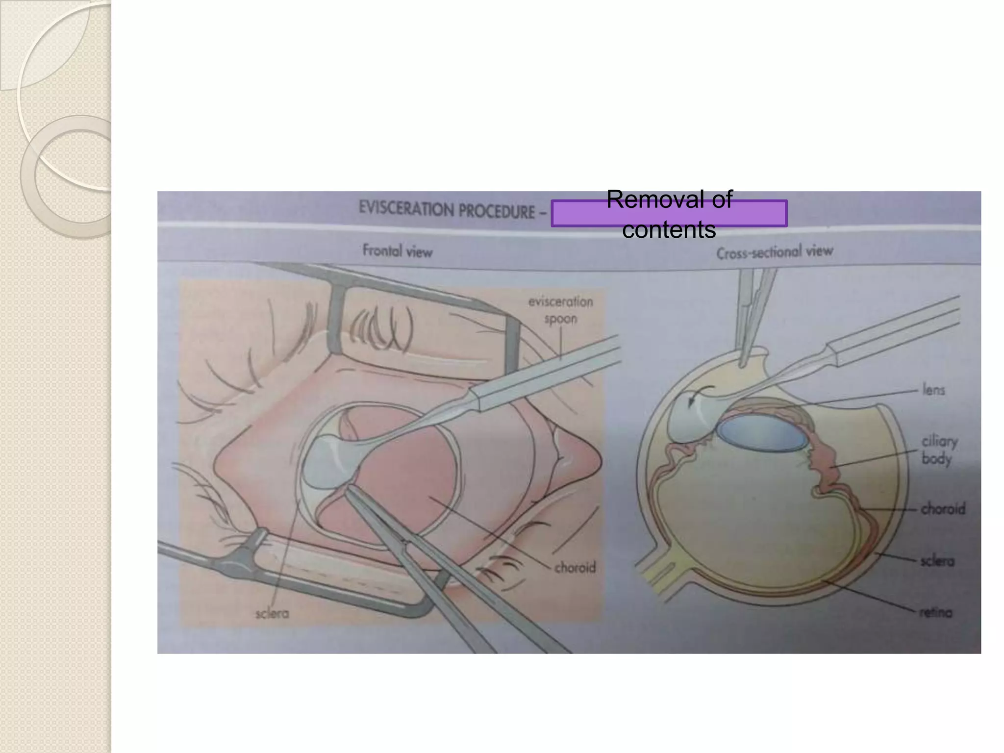 Congenital anophthalmia | PPT