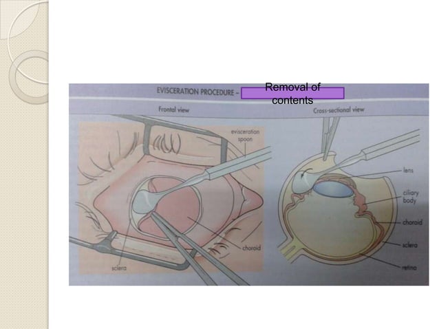 Congenital anophthalmia | PPT