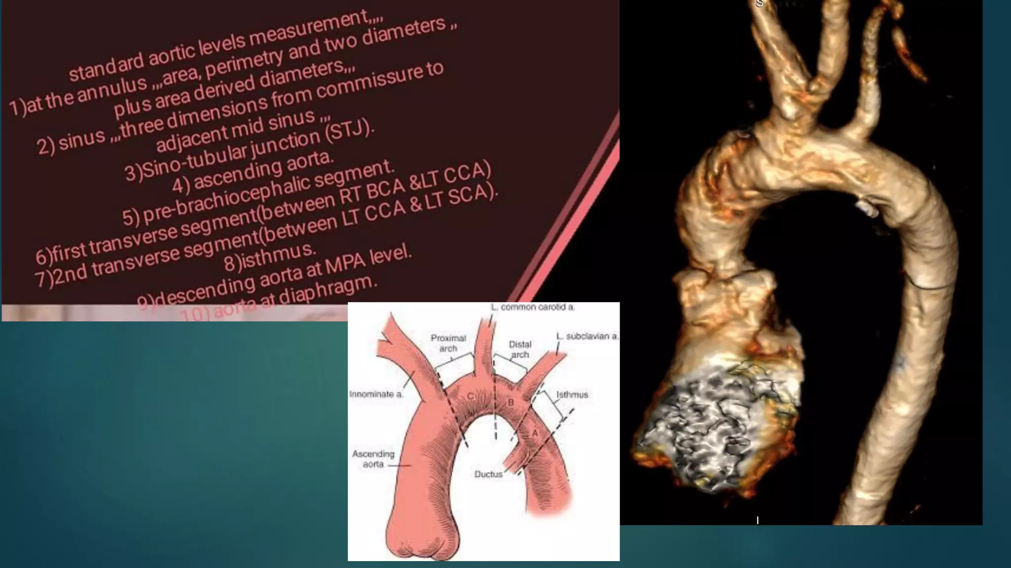 Congenital aortic diseases by MSCT | PDF