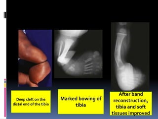 Congenital band syndrome | PPTX