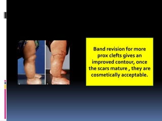 Congenital band syndrome | PPTX