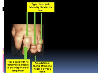 Congenital band syndrome | PPTX