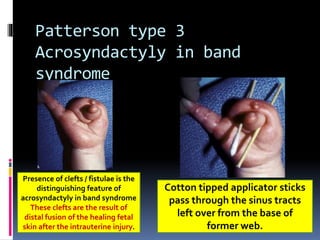Congenital band syndrome | PPTX