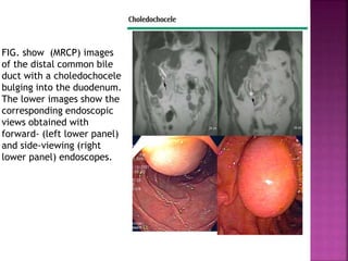 Congenital bile duct anomalies | PPTX