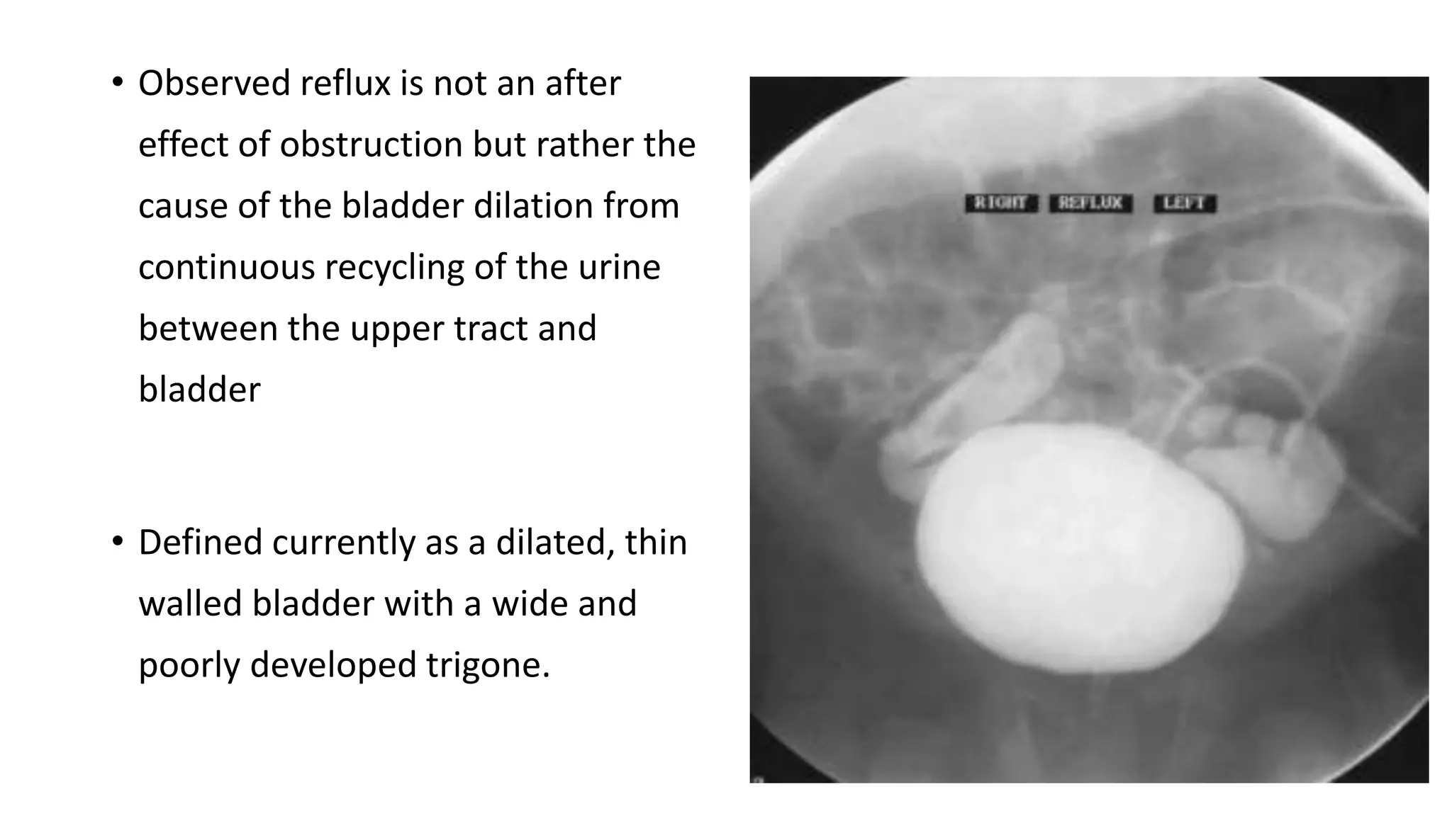 Congenital bladder disorders | PPTX