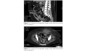 Congenital bladder disorders | PPTX