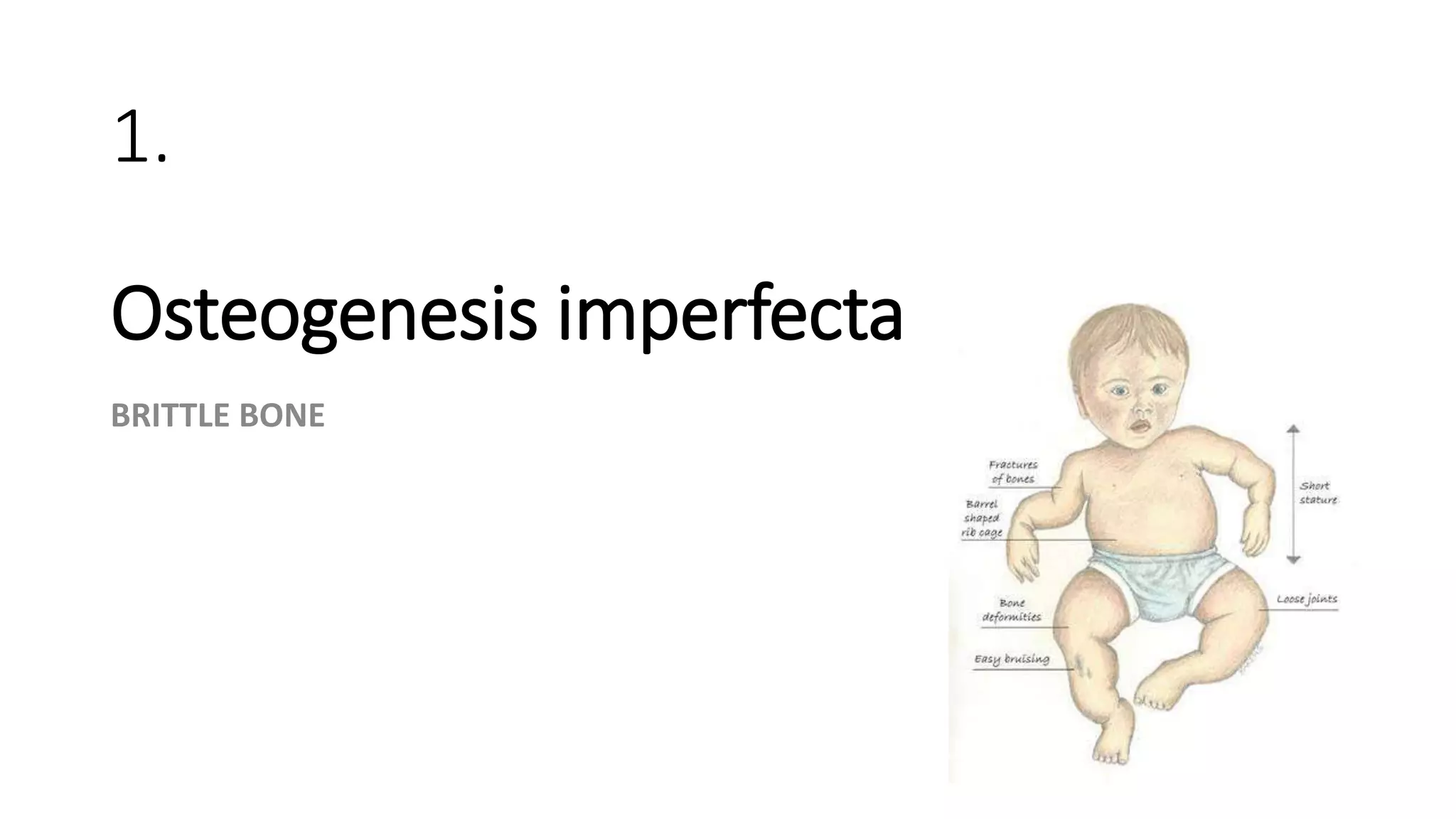 congenital bone and developmental disease of the bone.pptx