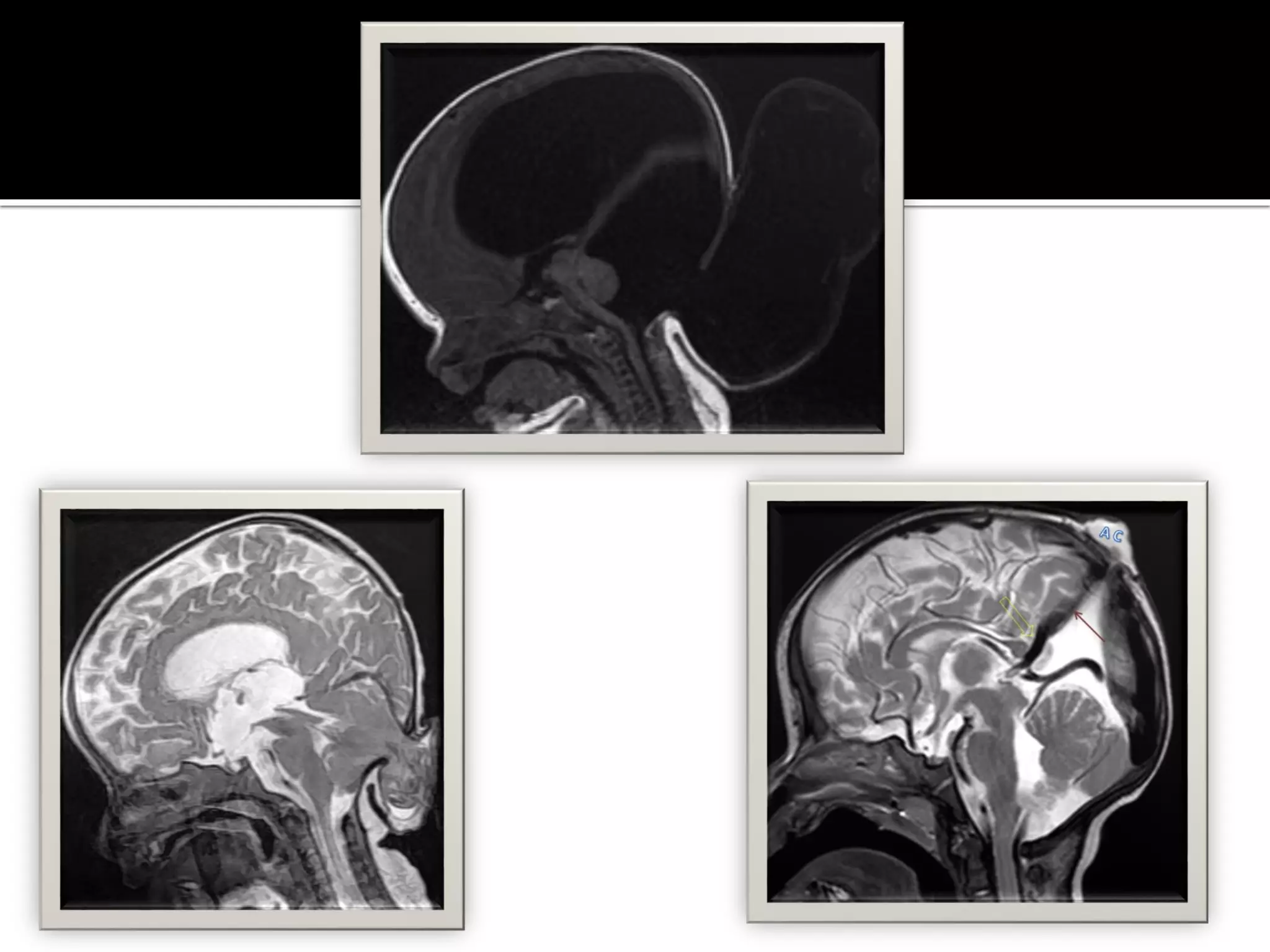 Congenital brain anomalies | PDF