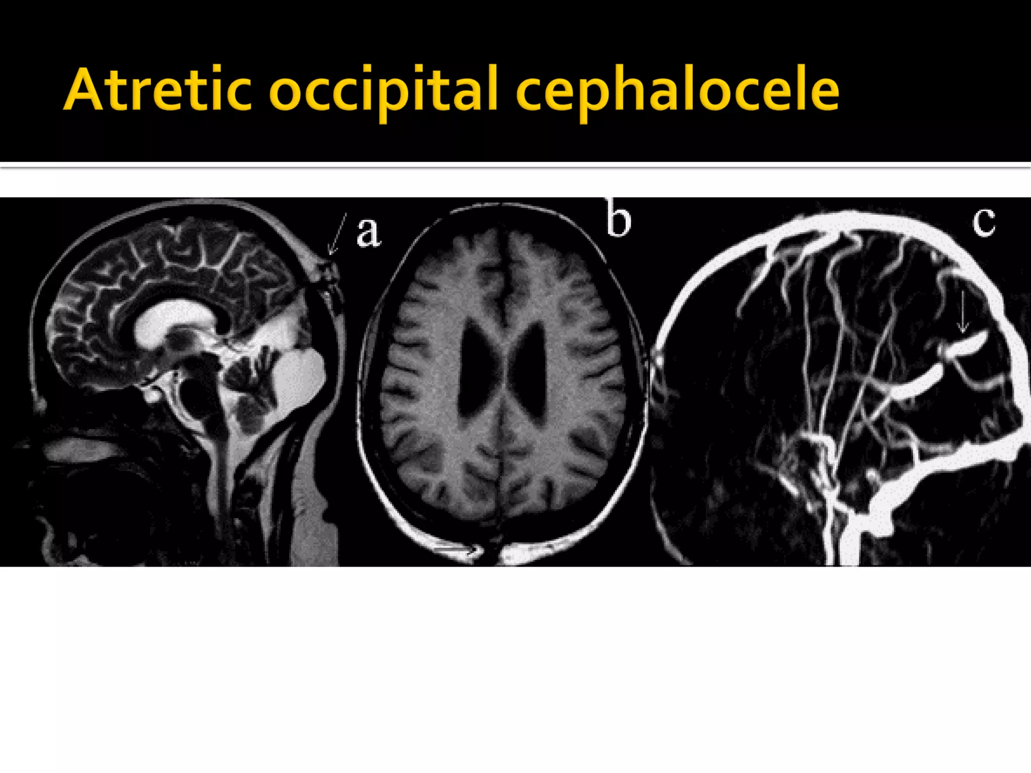 Congenital brain anomalies | PDF
