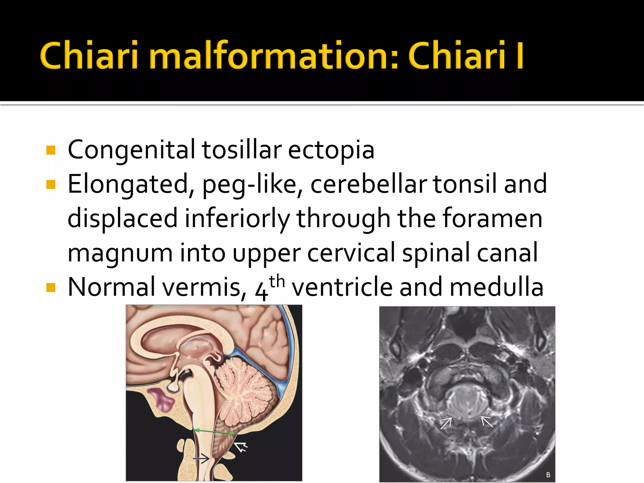 Congenital brain anomalies | PDF
