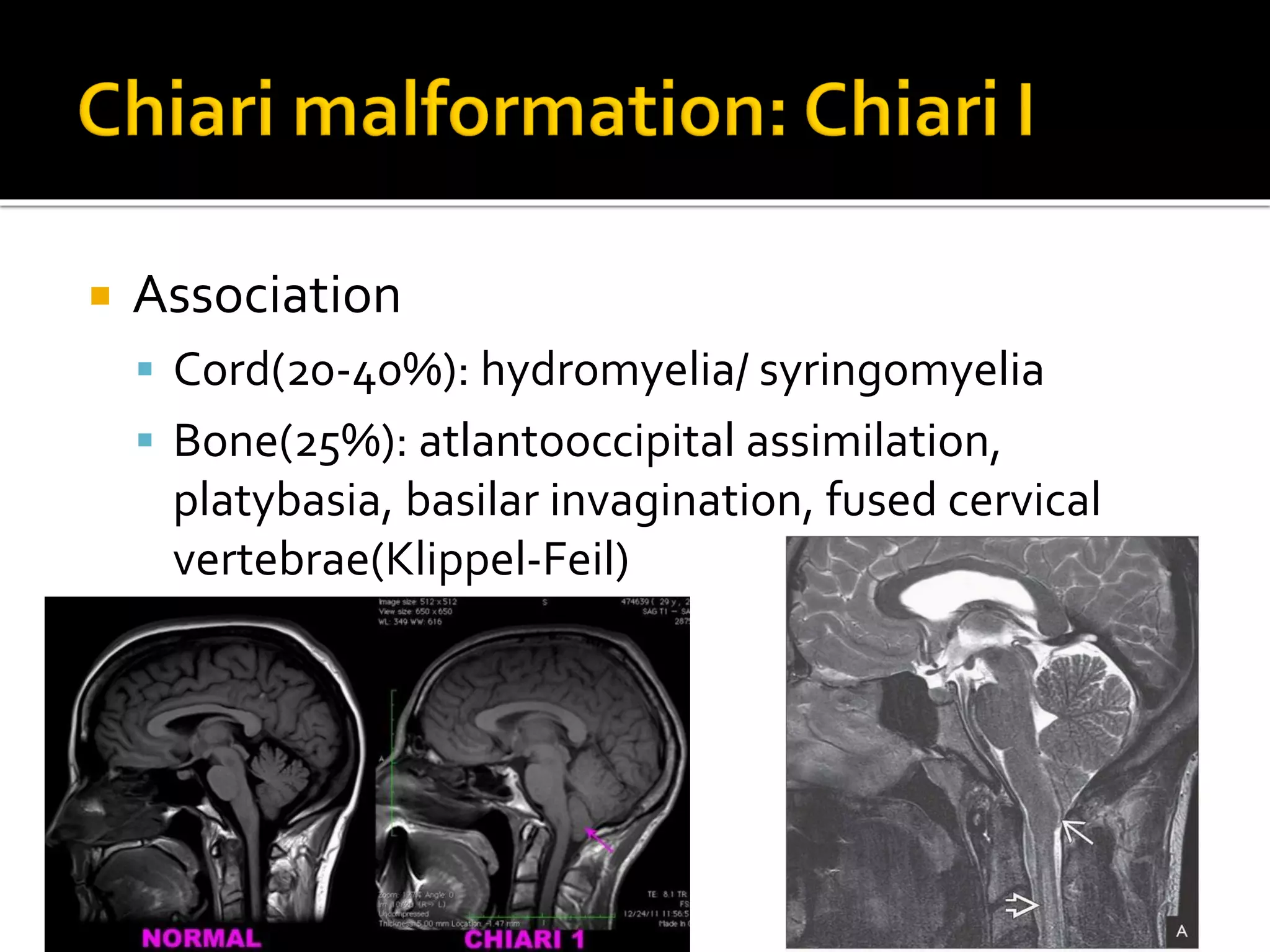 Congenital brain anomalies | PDF