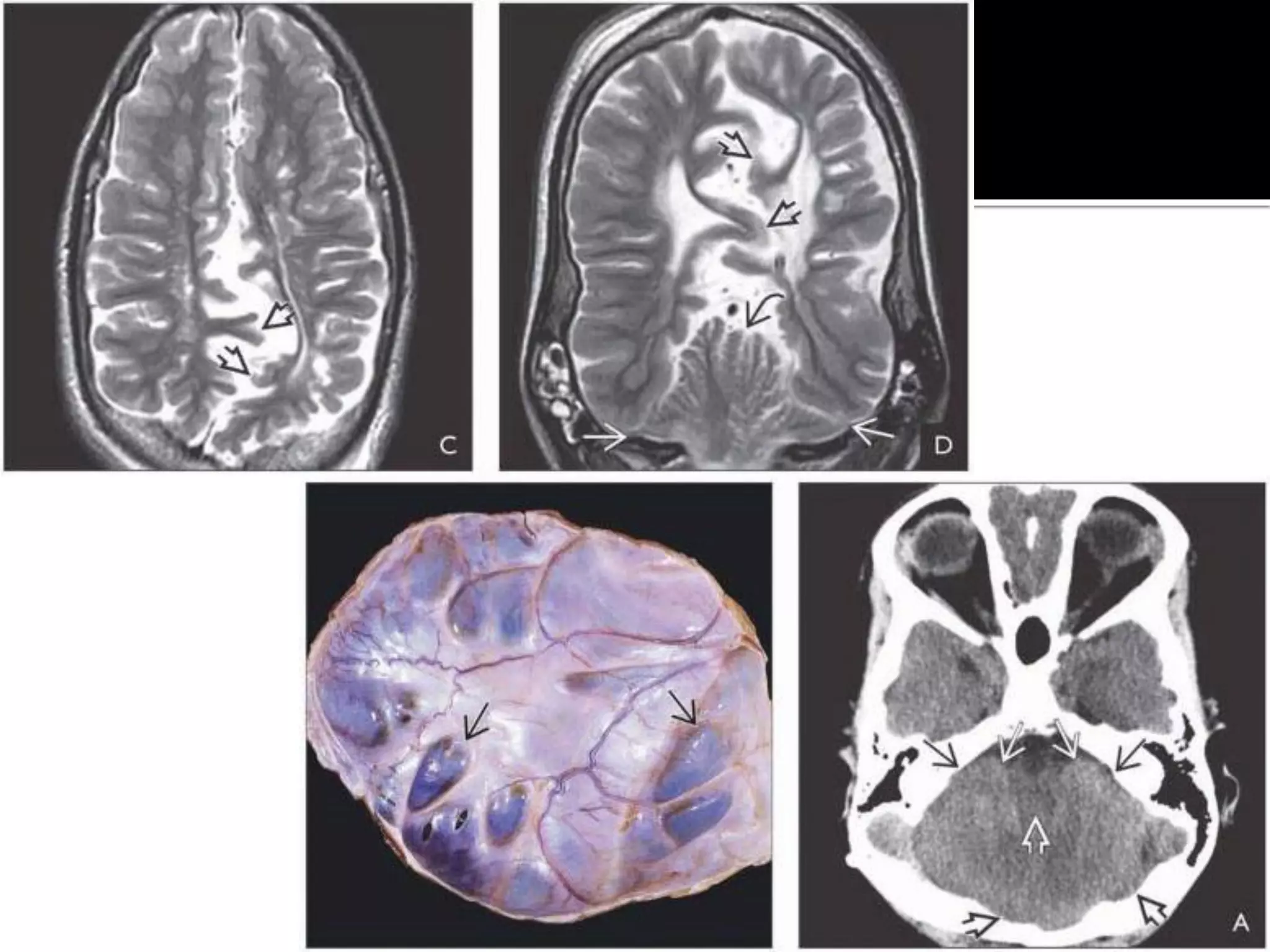 Congenital brain anomalies | PDF