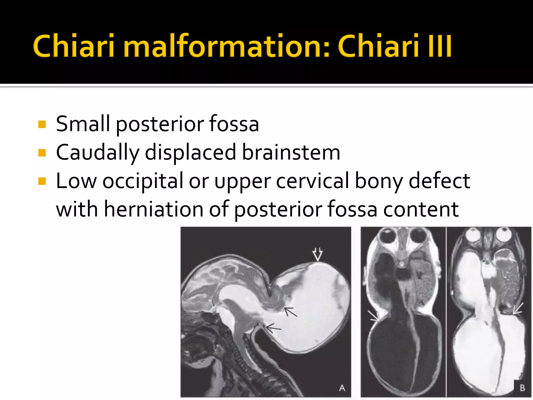 Congenital brain anomalies | PDF
