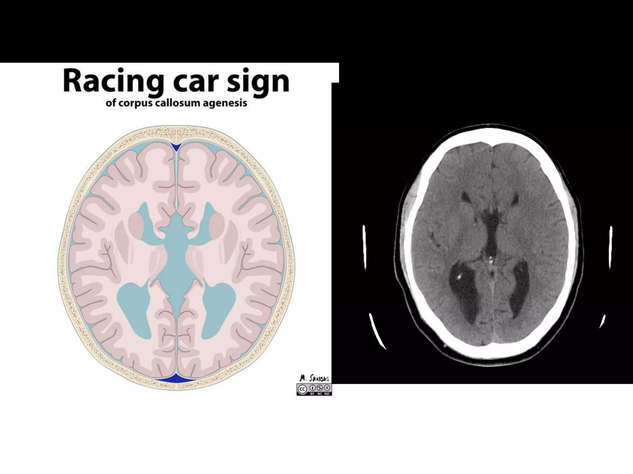 Congenital brain anomalies | PDF