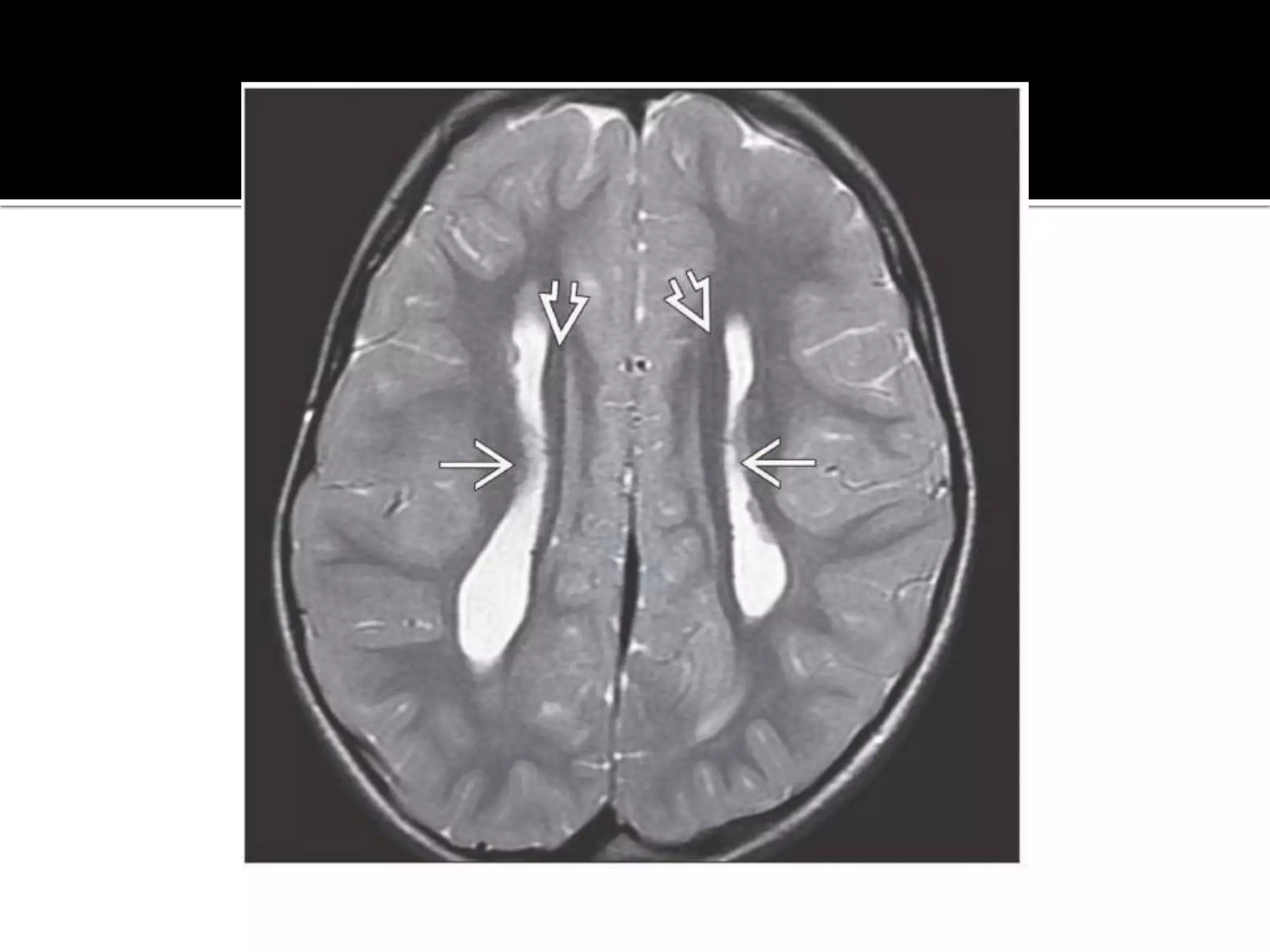 Congenital brain anomalies | PDF