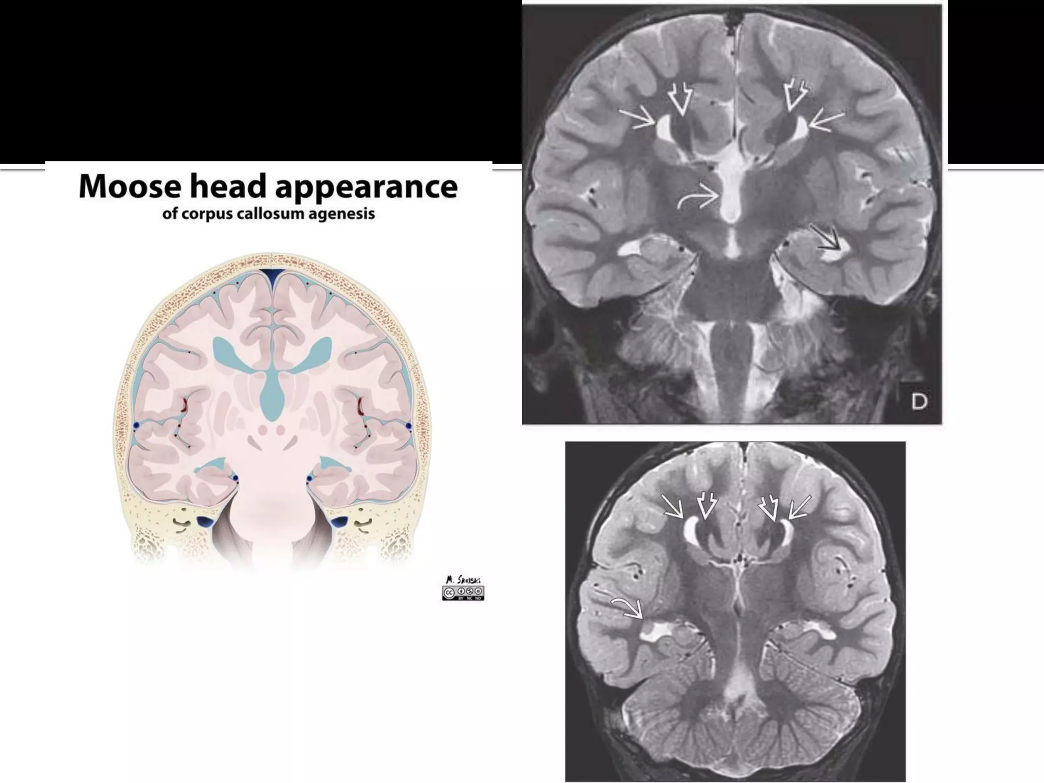 Congenital brain anomalies | PDF