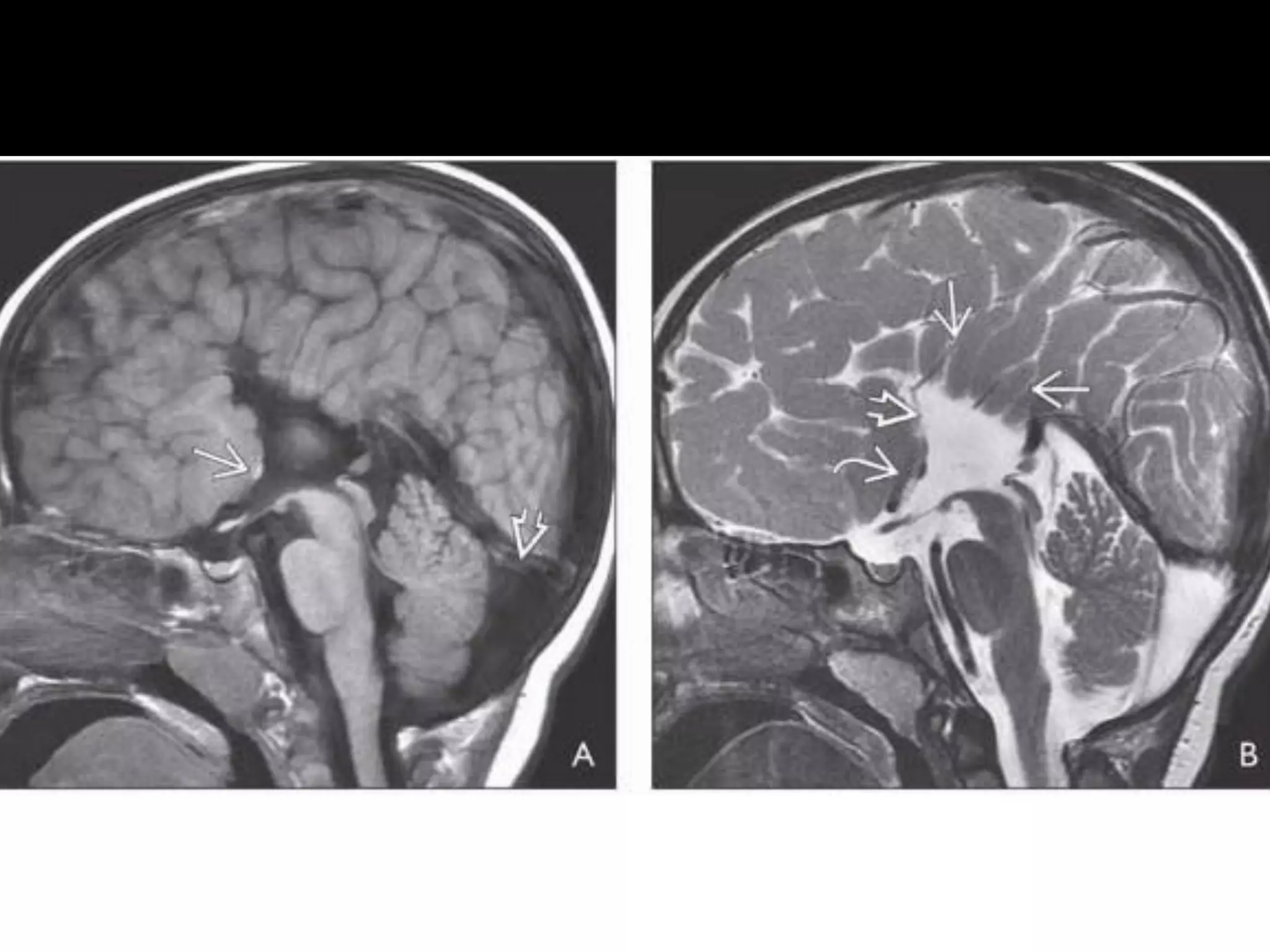 Congenital brain anomalies | PDF