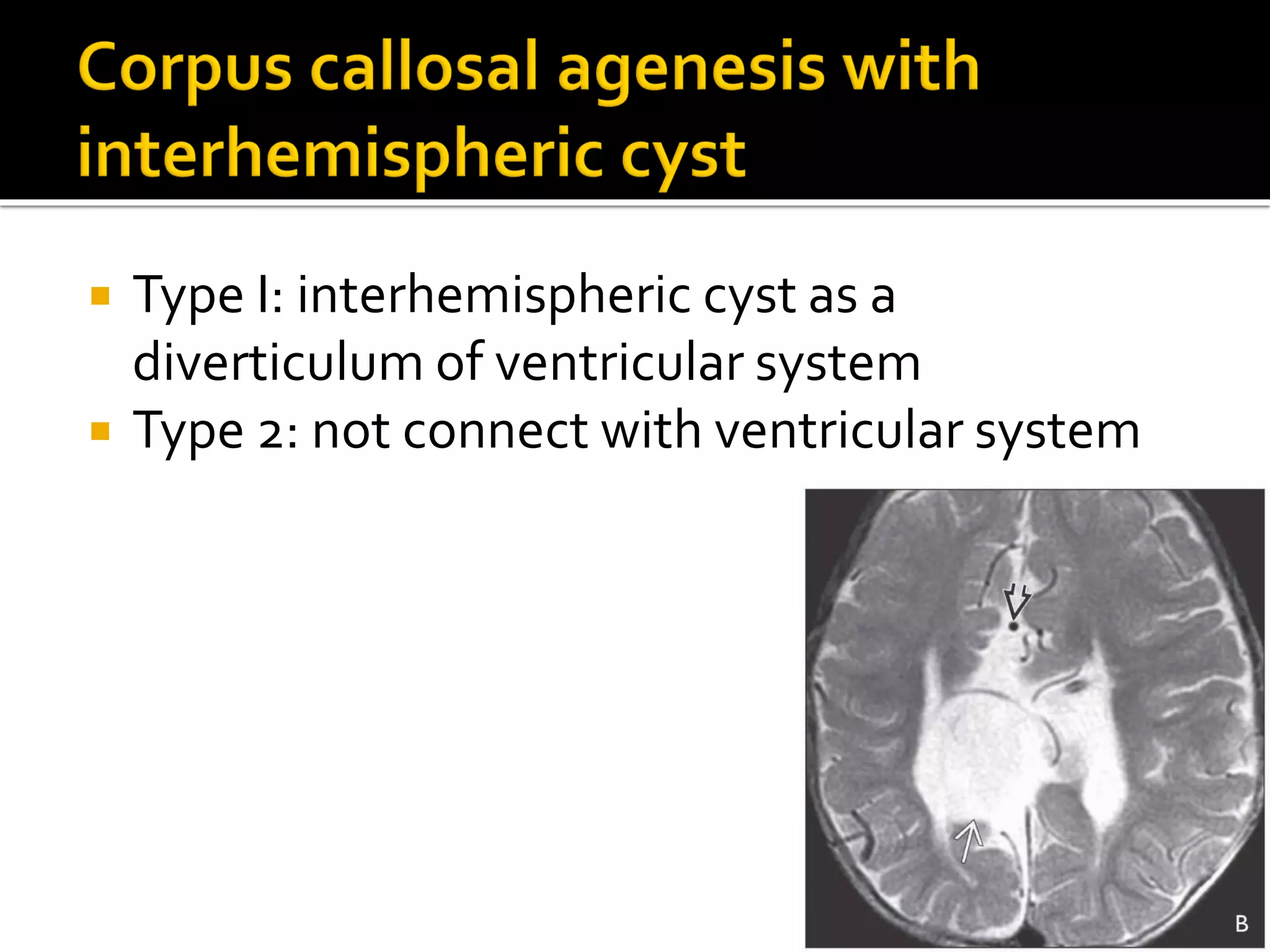 Congenital brain anomalies | PDF
