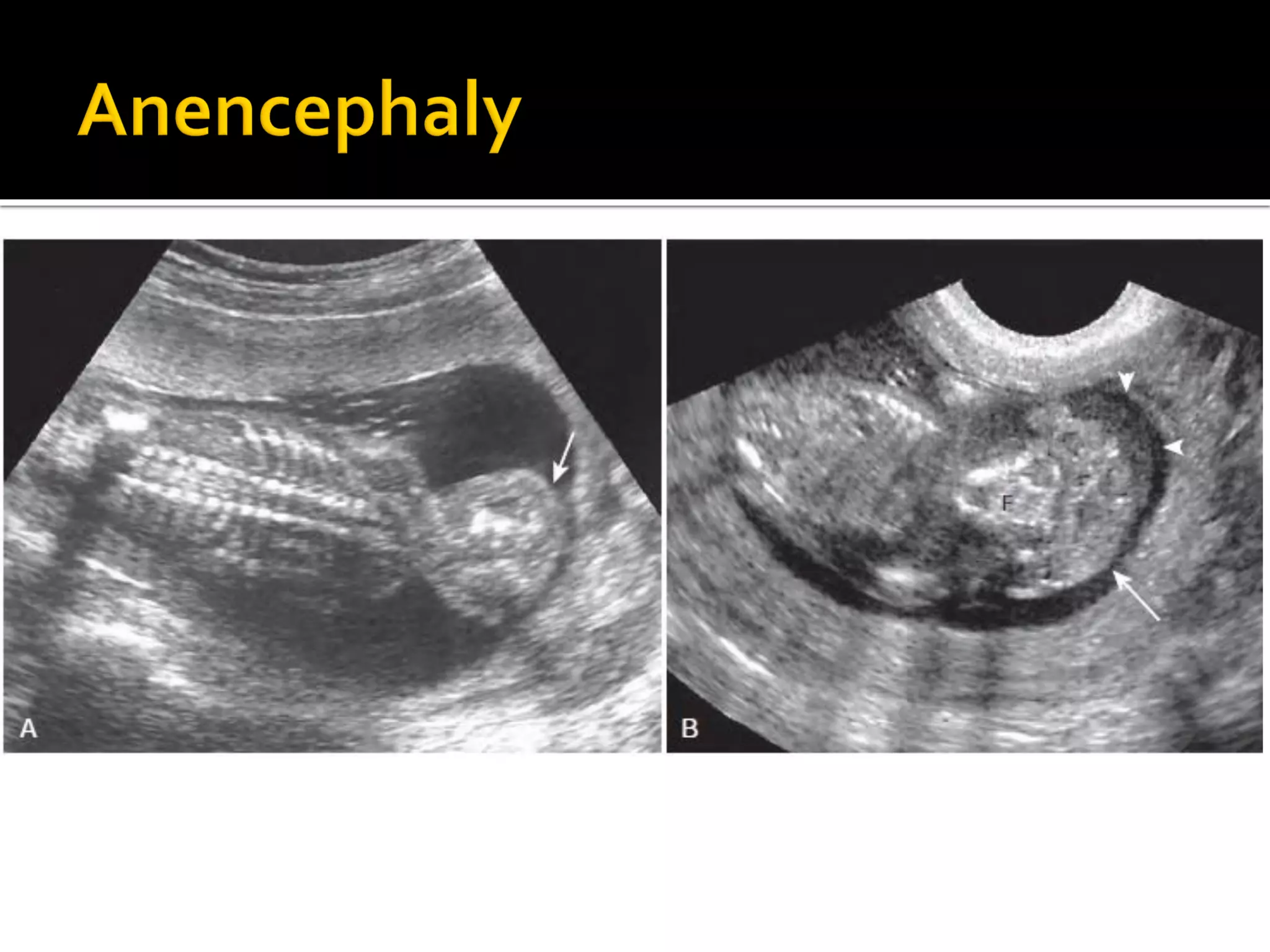 Congenital brain anomalies | PDF