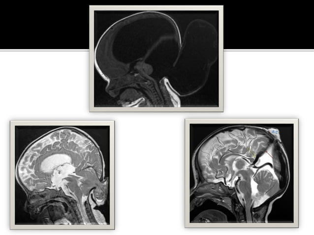 Congenital brain anomalies | PDF | Brain and Nervous System Disorders ...