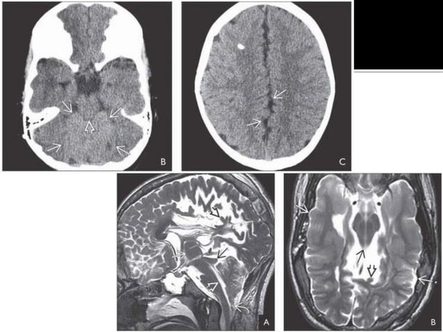 Congenital brain anomalies | PDF | Brain and Nervous System Disorders ...