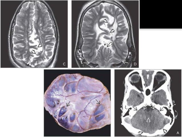 Congenital brain anomalies | PDF | Brain and Nervous System Disorders ...