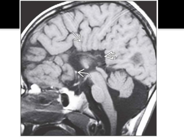 Congenital brain anomalies | PDF | Brain and Nervous System Disorders ...
