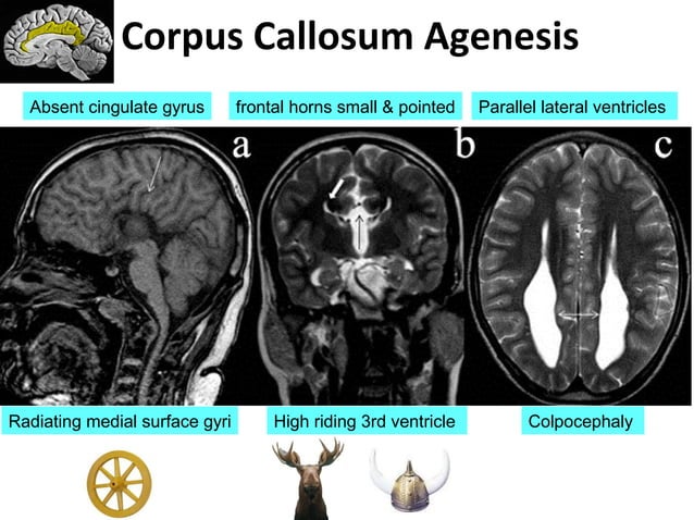 Congenitalbrainmalformations 150913122145-lva1-app6891 | PPT