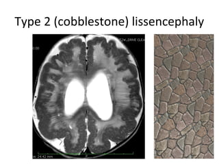 Cobblestone Lissencephaly