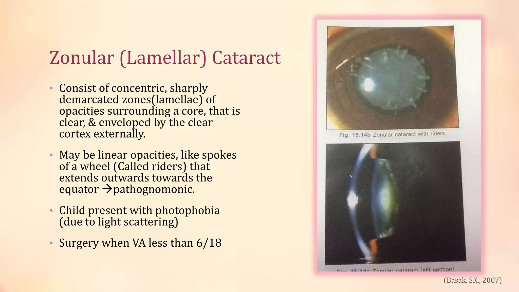 Congenital cataract | PPTX
