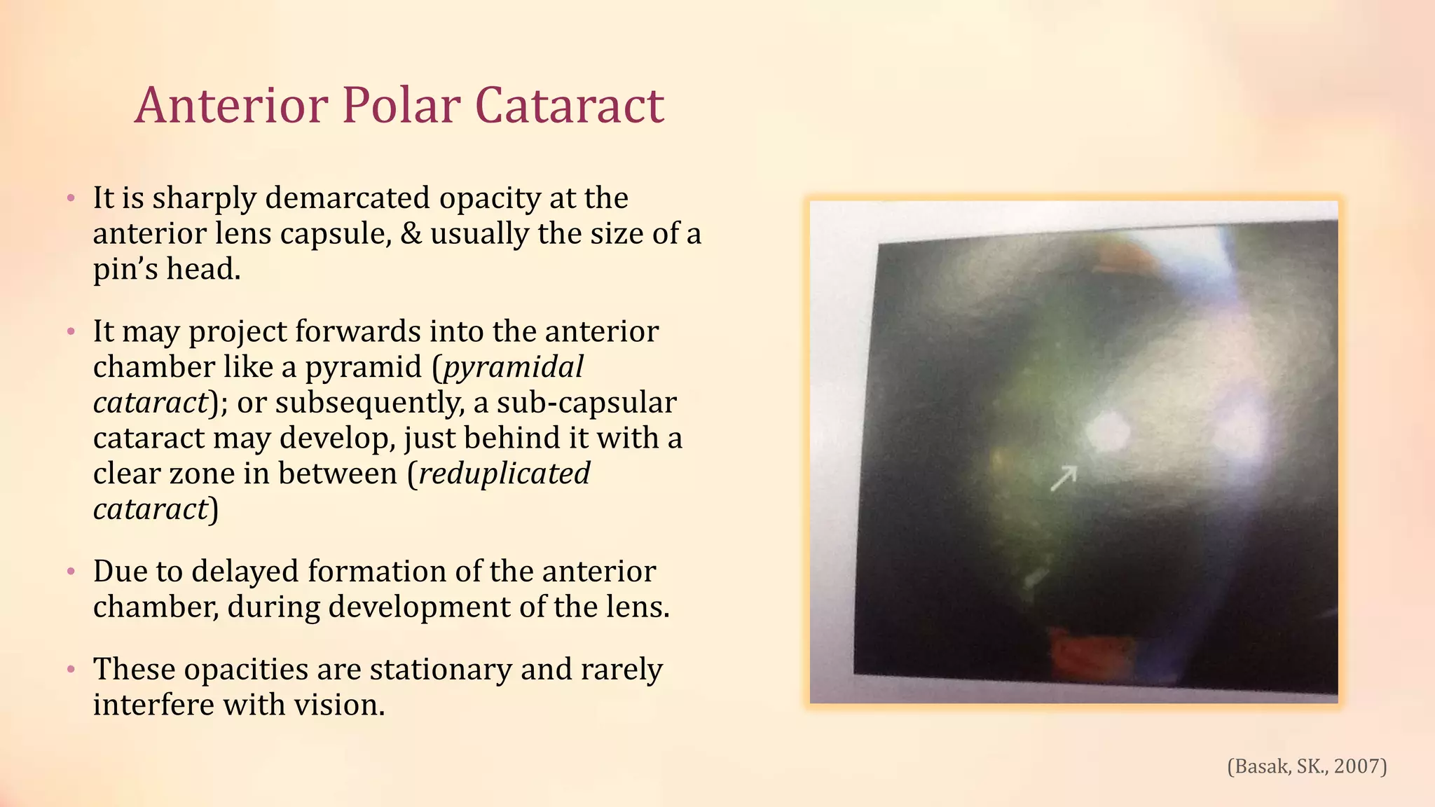 Congenital cataract | PPTX