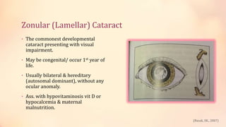 Zonular Cataract