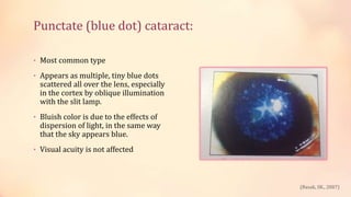 Blue Dot Cataract
