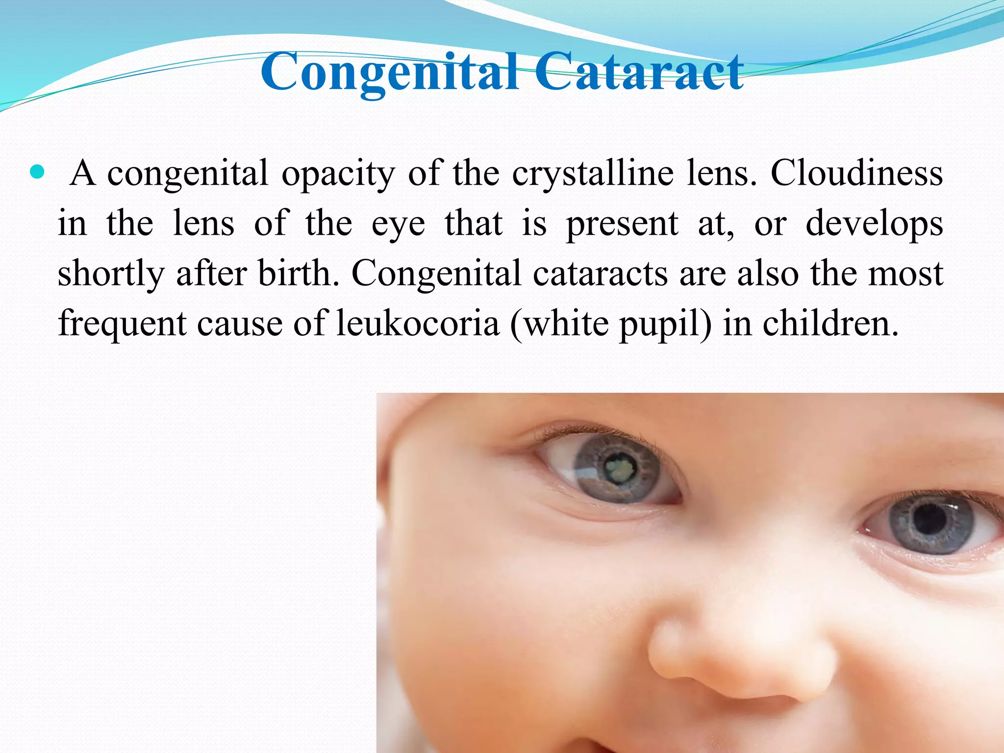 Congenital cataract | PDF