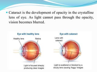 Congenital cataract | PDF