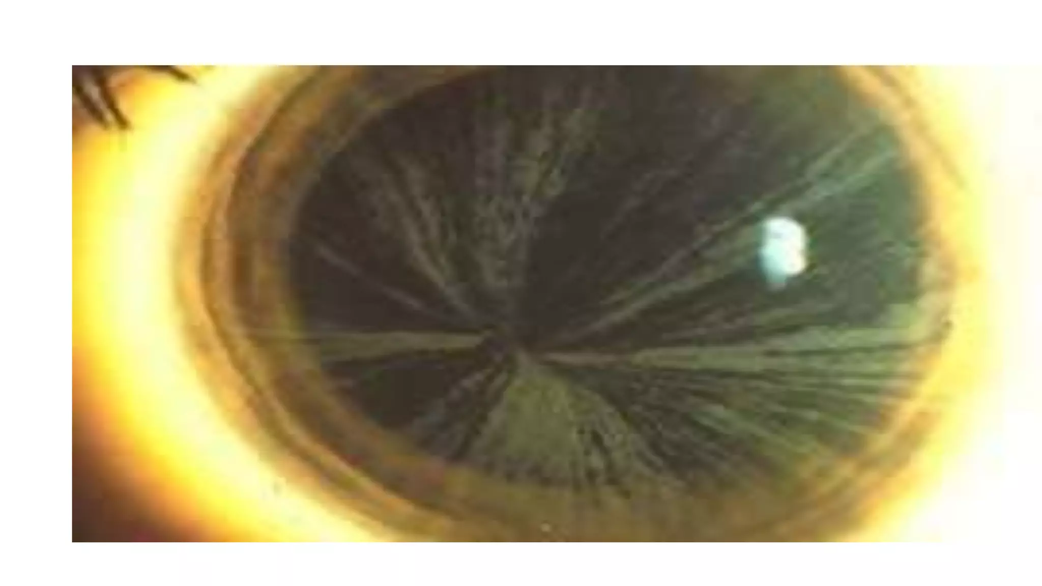 Congenital cataract | PPTX