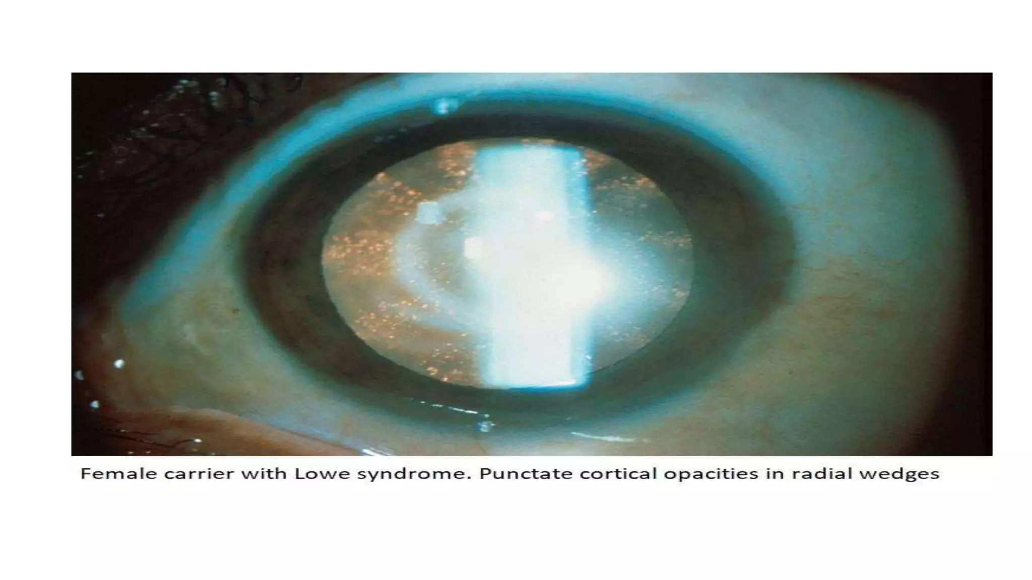 Congenital cataract | PPTX